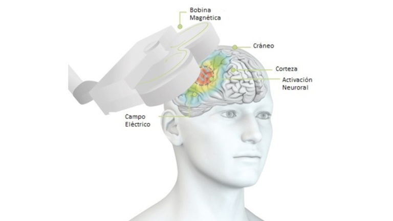 Estimulación Magnética Transcraneal Repetitiva (rTMS) – Brain-focused.com
